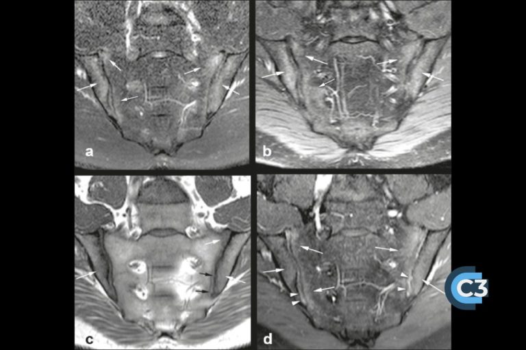 A Workers' Compensation Adjuster's Guide to Acute vs. Chronic Injuries ...